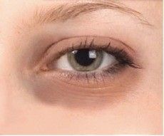 Ojeras. Causas y tratamiento | CuidaTuVista.com