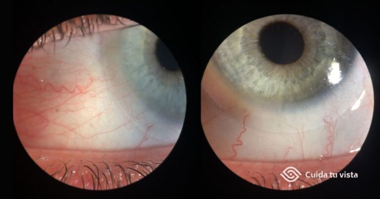 Causas OJOS ROJOS, que HACER y que EVITAR con el Dr. Ollero