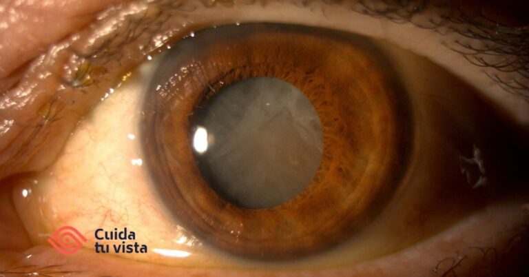 Operación de CATARATAS. El Dr. Ollero te explica TODO Fácil