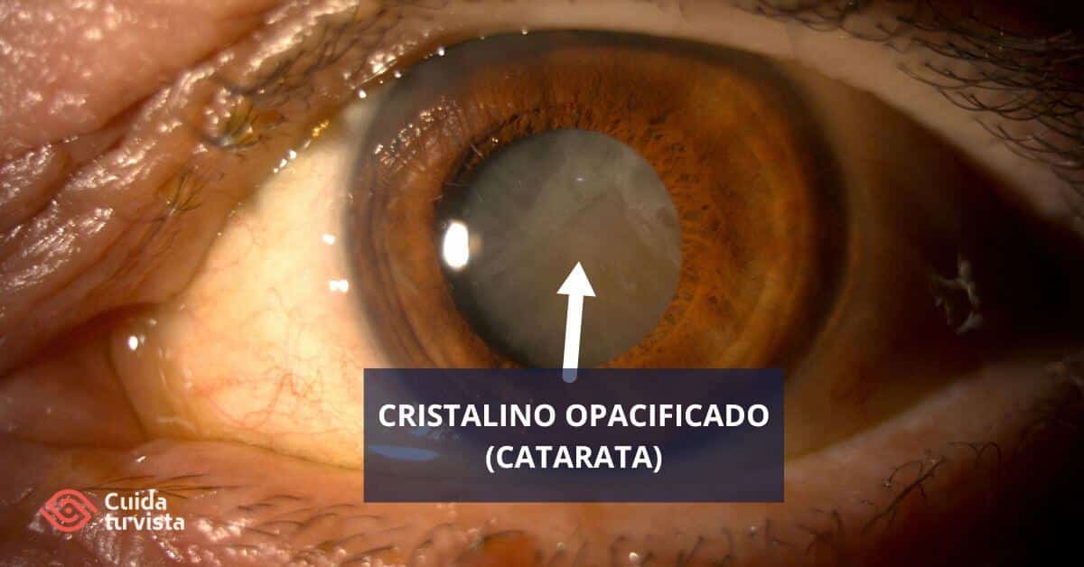 Cristalino del ojo ¿Qué es y cuál es su función?